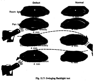 State the swinging flashlight test, Biology